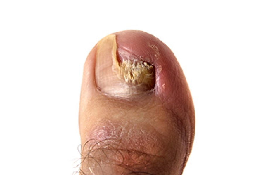 Causes and Risk Factors of Split Toenails